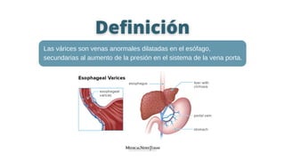 Varices esofágicas (1) | PDF