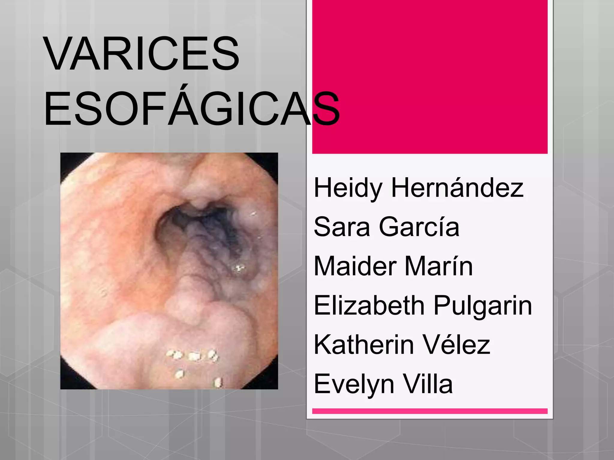 Varices esofágicas | PPTX