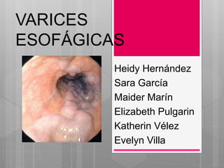 Varices esofágicas | PPTX