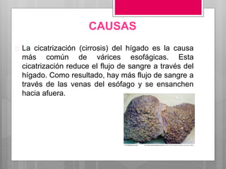 Varices esofágicas | PPTX