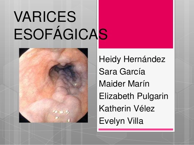 Varices esofágicas
