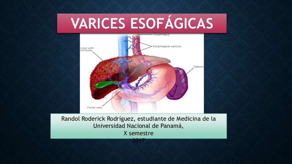 Varices esofágicas