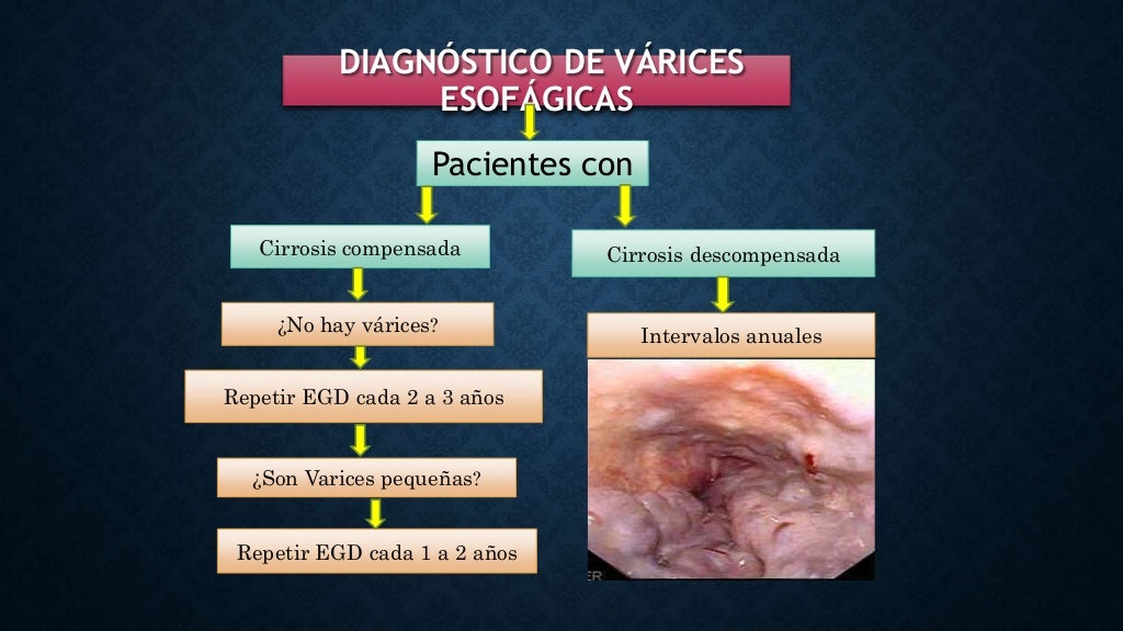 Varices esofágicas
