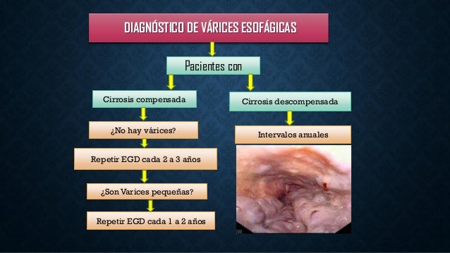 Varices esofágicas