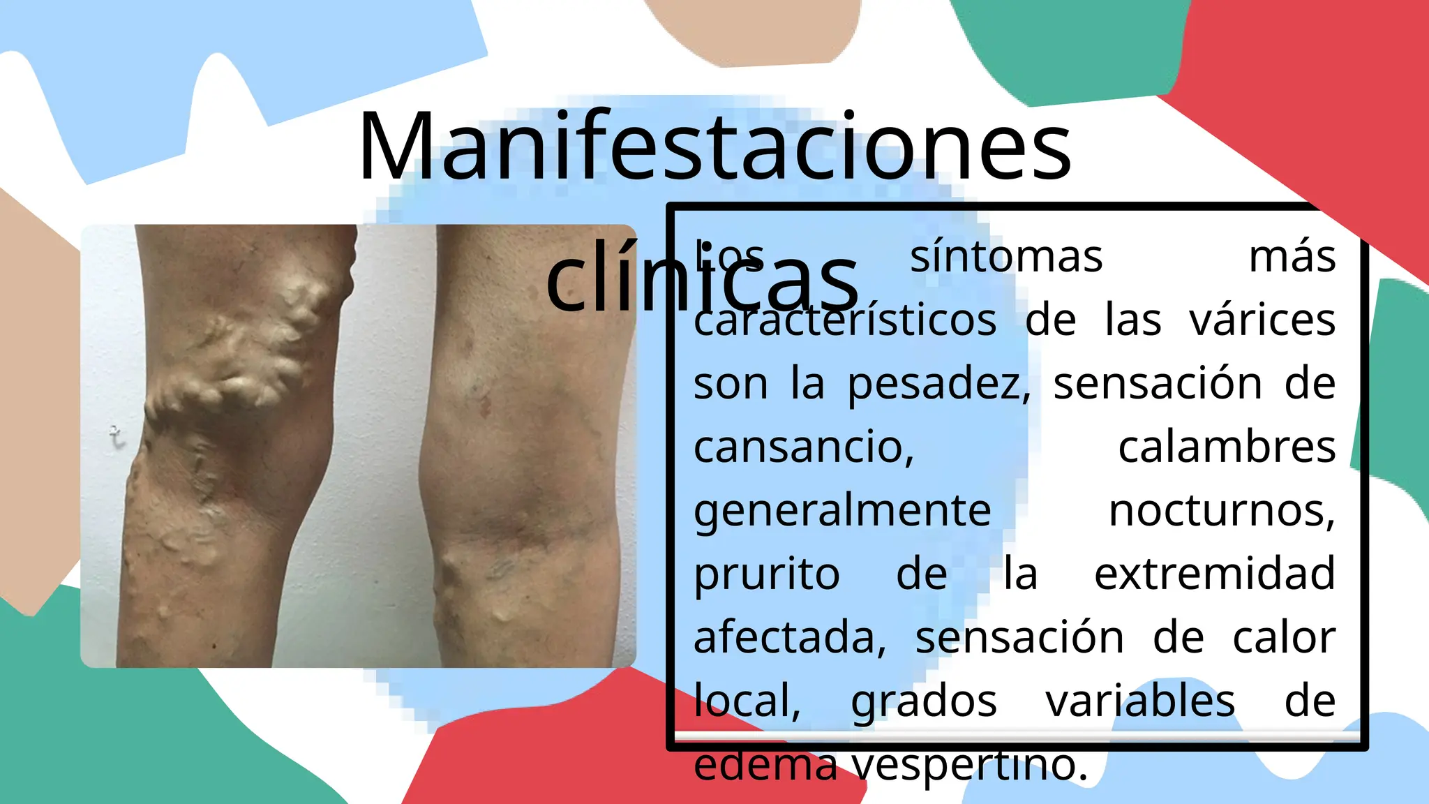 Varices en miembros inferiores, complicaciones | PPT