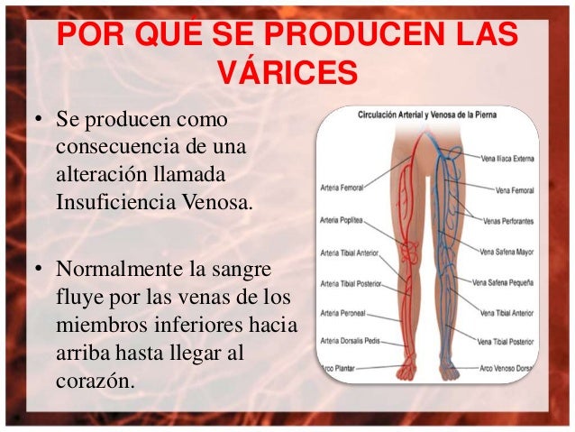 Varices treatment in Mexico,Cancun & Tijuana at affordable Cost