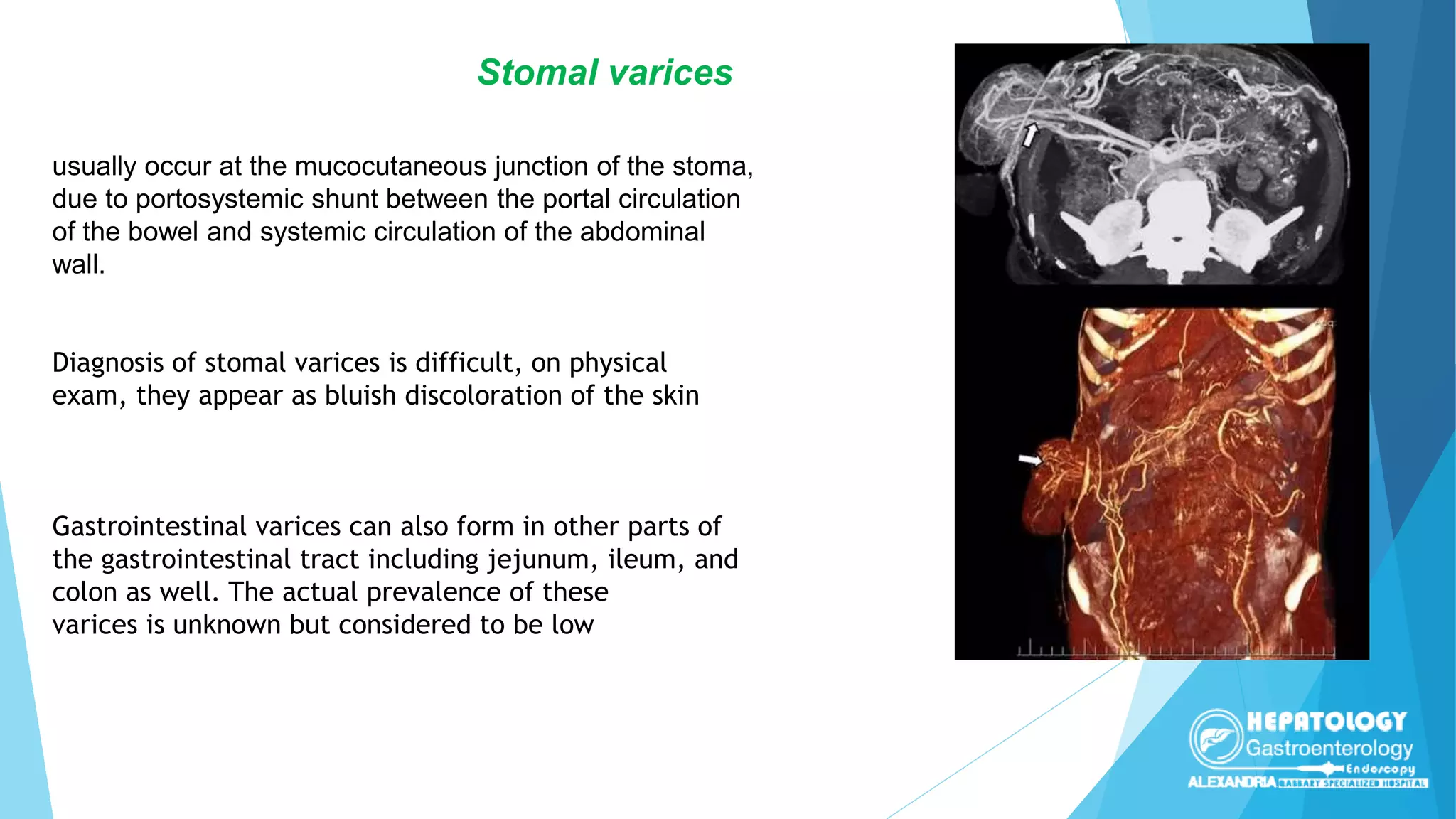 Varices Types and sites.pptx