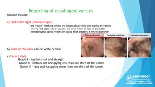 Varices Types and sites.pptx
