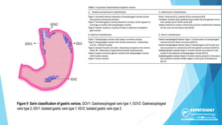 Varices Types and sites.pptx