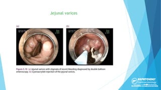 Varices Types and sites.pptx