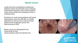 Varices Types and sites.pptx