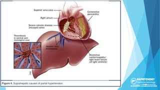 Varices Types and sites.pptx