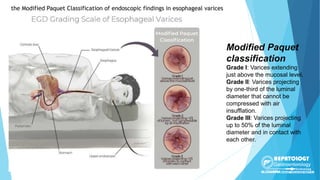 Varices Types and sites.pptx
