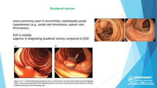 Varices Types and sites.pptx