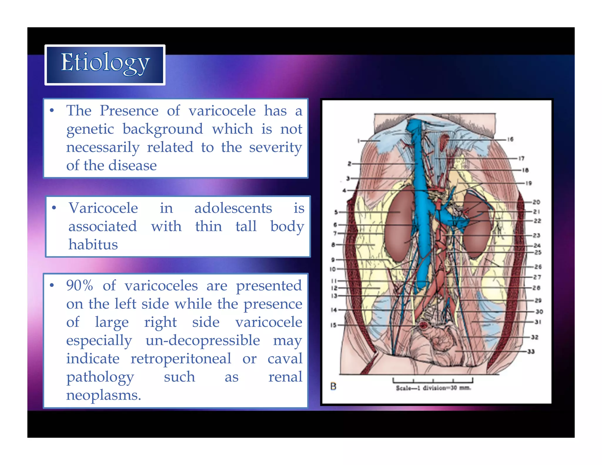 Varicocele | PDF