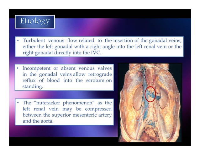 Varicocele | PDF | Infertility | Reproductive Health