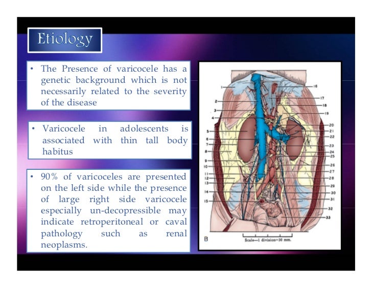Varicocele