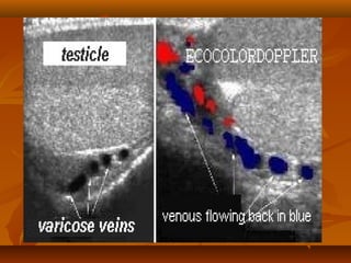 Varicocele | PPT