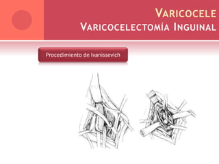 Varicocele | PPTX