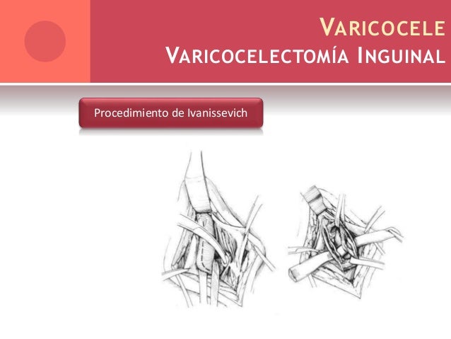 Varicocele