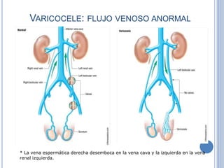Varicocele, reflujo vesicoureteral y | PPTX