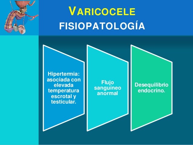 Varicocele