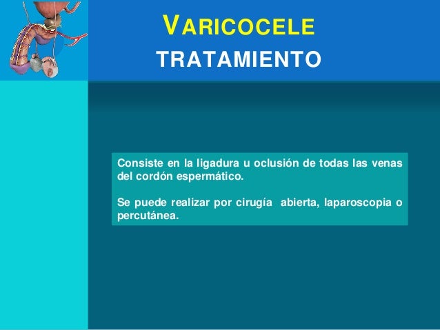Varicocele