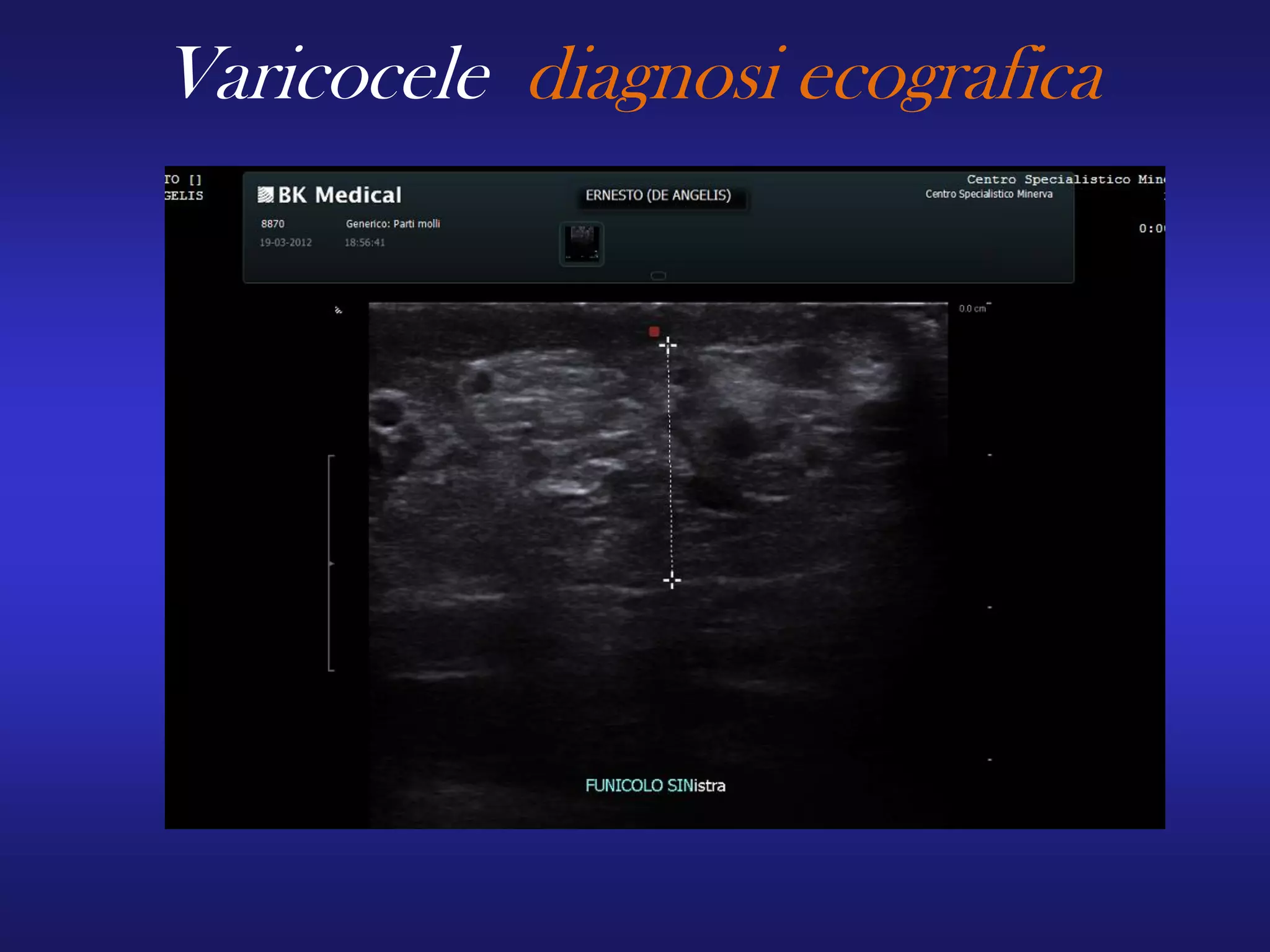 Varicocele | PPT