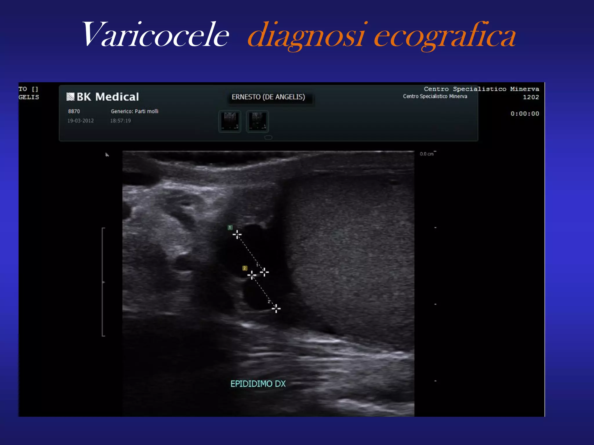 Varicocele | PPT