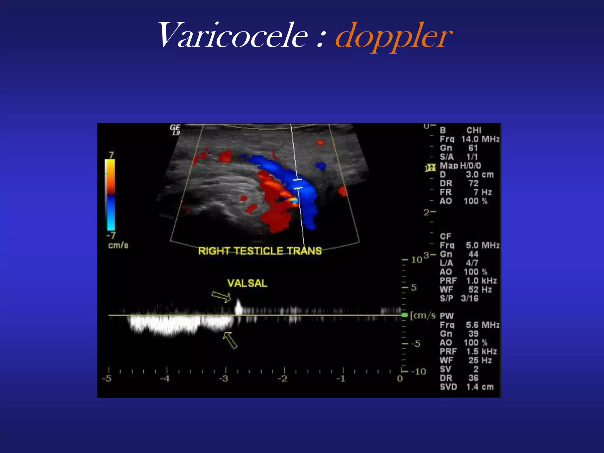 Varicocele | PPT