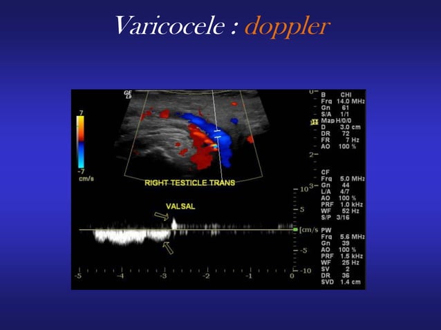 Varicocele | PPT