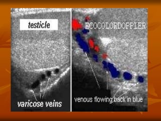 Varicocele | PPT