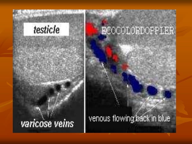 Varicocele | PPT | Infertility | Reproductive Health