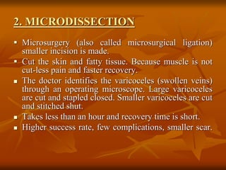 Varicocele | PPT