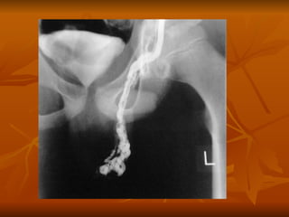 varicocele-200430092536 (1)hghsbsbsnb.ppt