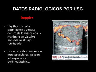 Varicocele Radiología | PPTX