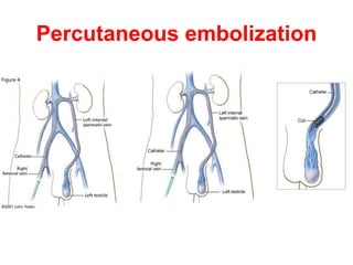 Varicocele.ppt