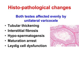 Varicocele.ppt