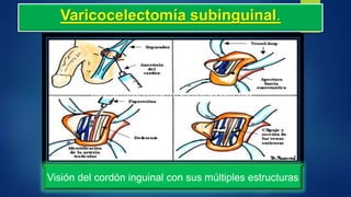 VARICOCELE.pptx