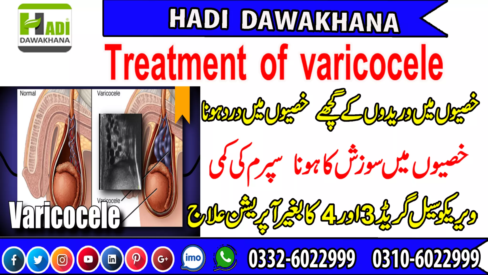 Varicocele ka ilaj | Varicocele Treatment | PDF