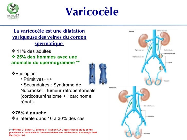 Varicocele Amu 2010