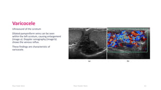 Varicocele and hydrocele.pdfjjhhhjjjjjjh | PDF