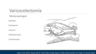 Varicocele y varicocelectomía tratamiento quirúrgico | PPTX