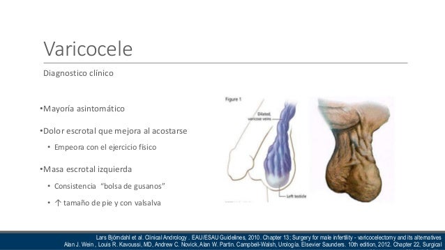 Varicocele Y Varicocelectomía Tratamiento Quirúrgico
