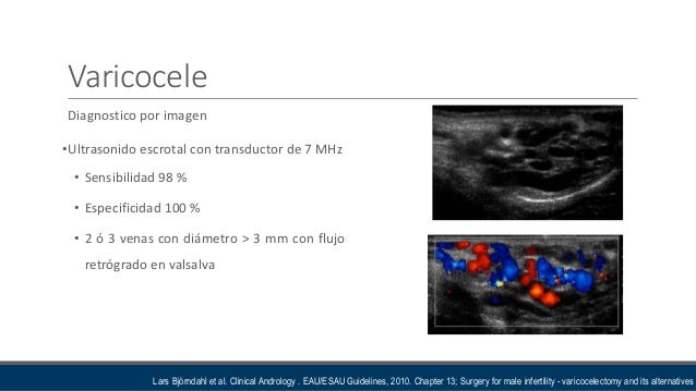 Ultrassonografia De Varicocele