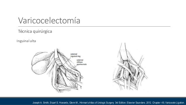 VARICOCELECTOMIA TECNICA QUIRURGICA PDF
