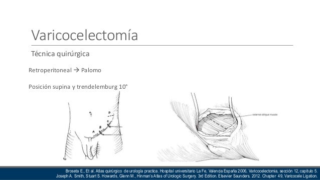 Varicocele Y Varicocelectomía Tratamiento Quirúrgico