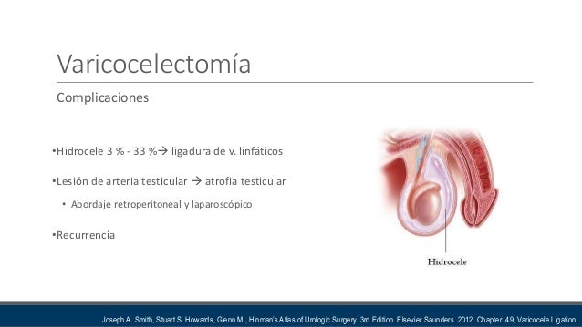 Varicocele Y Varicocelectomía Tratamiento Quirúrgico