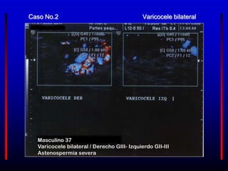 Varicocele - APROFE - Dr Victor Sanchez | PPSX