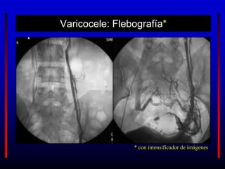 Varicocele - APROFE - Dr Victor Sanchez | PPSX